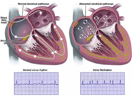 Silent Atrial Fibrillation - A Dangerous Condition | HubPages
