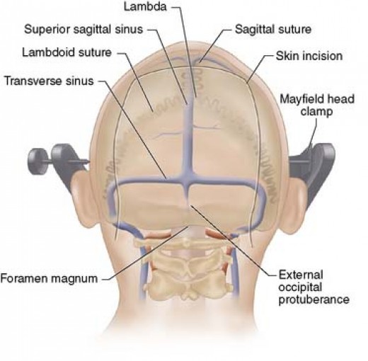 Occipital Transtentorial Approach | hubpages Occipital Transtentorial Approach | hubpages