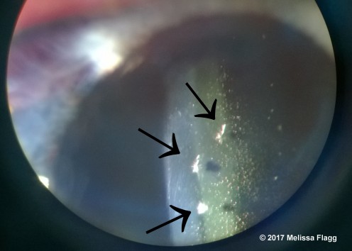 Definition of YAG Laser Posterior Capsulotomy | HealDove