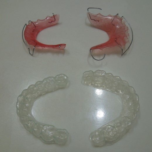 Braces for Kids: How Orthodontics Work | HubPages