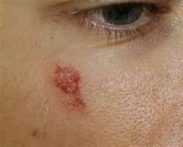 What Is Chagas Disease And Should You Worry? | hubpages