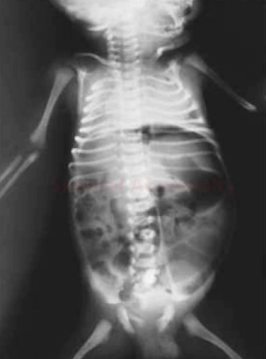 Patau Syndrome – Symptoms, Causes, Treatment, Pictures | hubpages