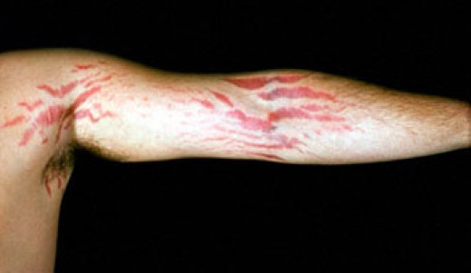 The Medical Relevance Of Diseases Of The Adrenal Cortex: Cushing’s ...