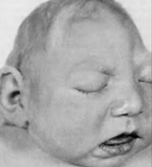 Microcephaly – Pictures, Life Expectancy, Causes, Symptoms, Treatment ...