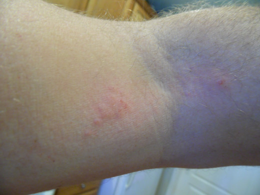 Poison Ivy Rash On Arm